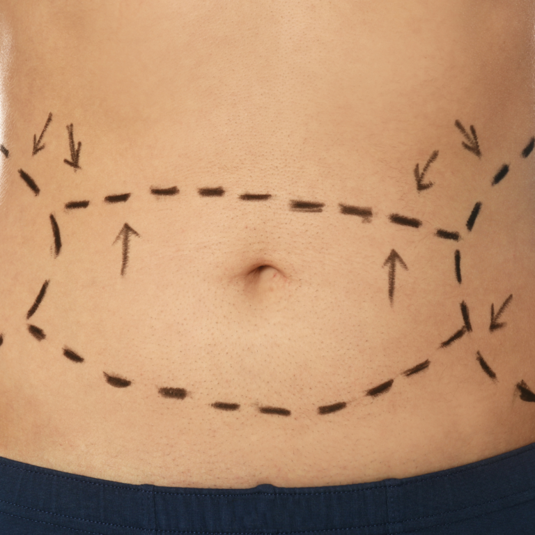 Say Goodbye to Scars: A Step-by-Step Guide to Post-Surgery Scar ...